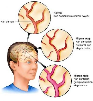 Migrenin Nedenleri Ve Çeşitleri Nelerdir? Migrene İyi Gelen Bitkiler ...