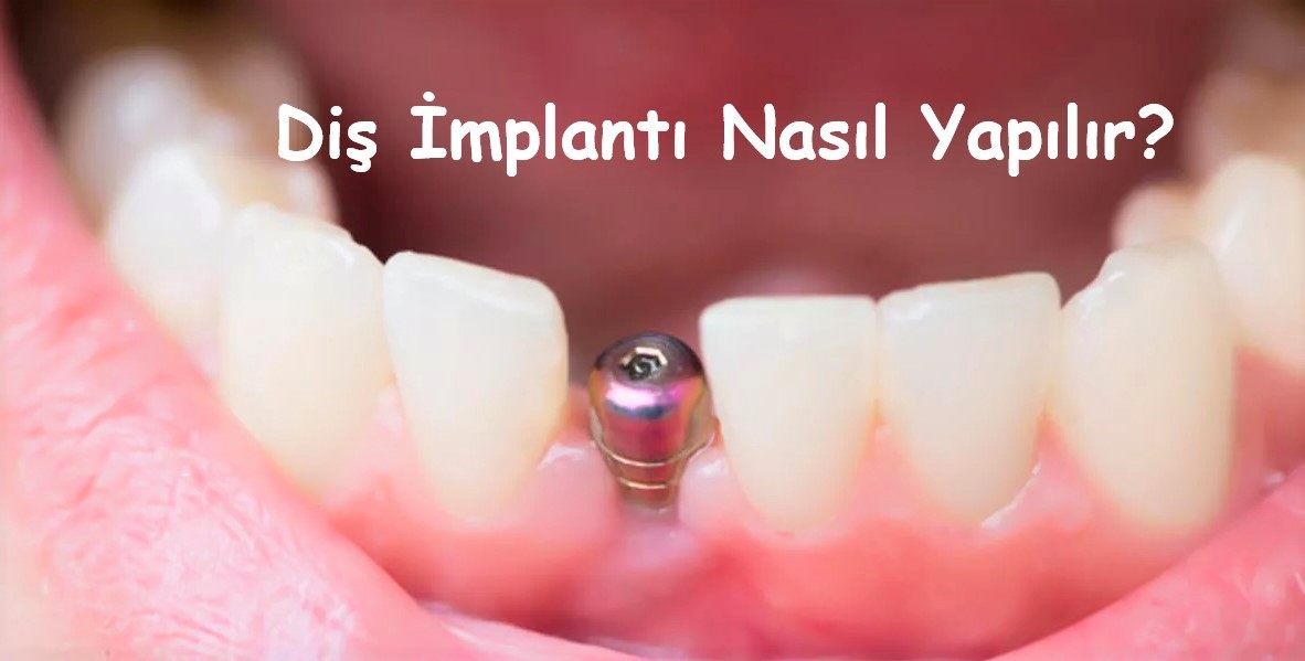 Diş İmplantı Nasıl Yapılır? - Güzel Bilgiler